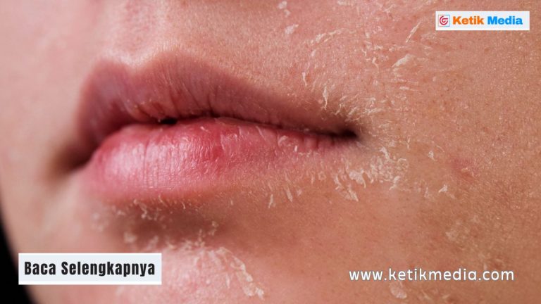 Penyakit Kulit Kering: Penyebab, Gejala dan Cara Mengatasinya