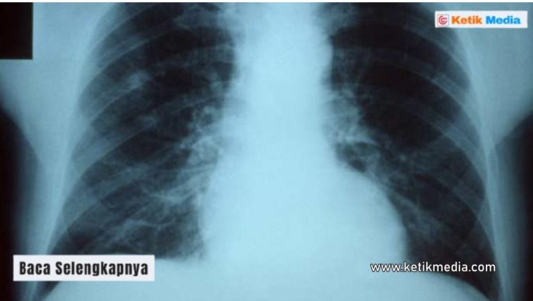 5 Tanda yang Menunjukkan Hasil Rontgen Paru-Paru Basah